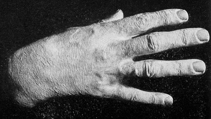 Franz Liszt s hand ; taken from a plaster cast . Hungarian composer ...