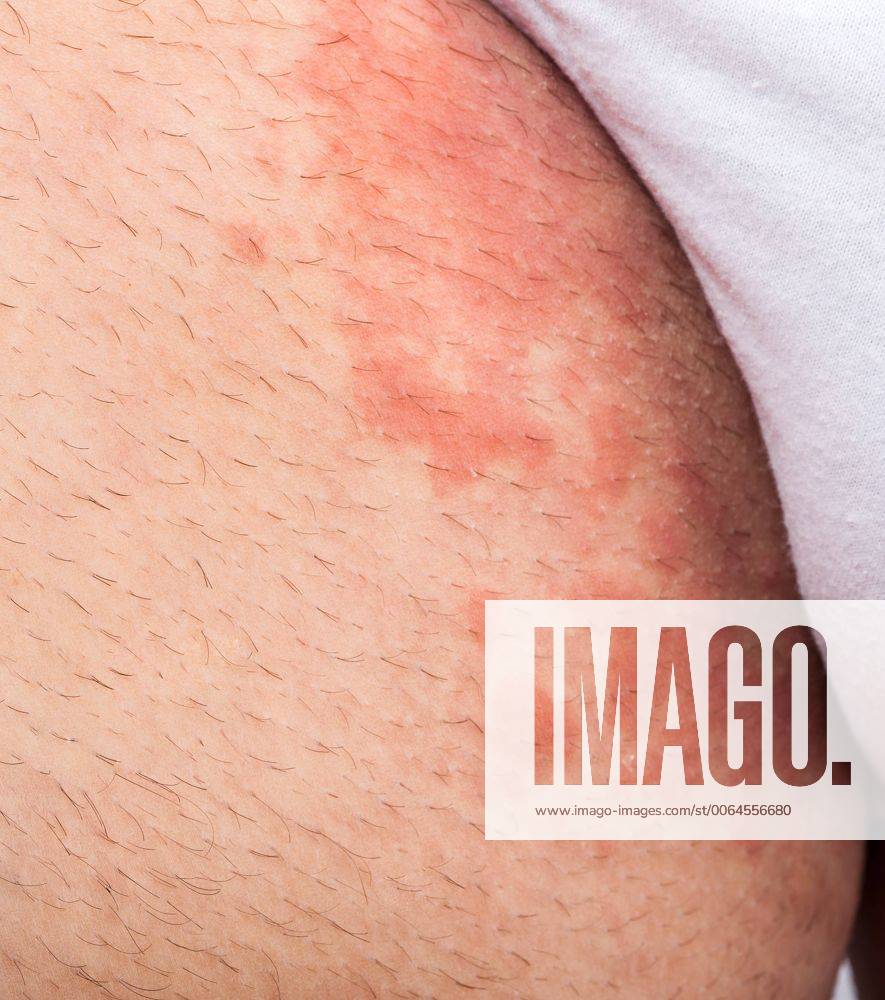 Eczema groin atopic dermatitis symptom of skin texture