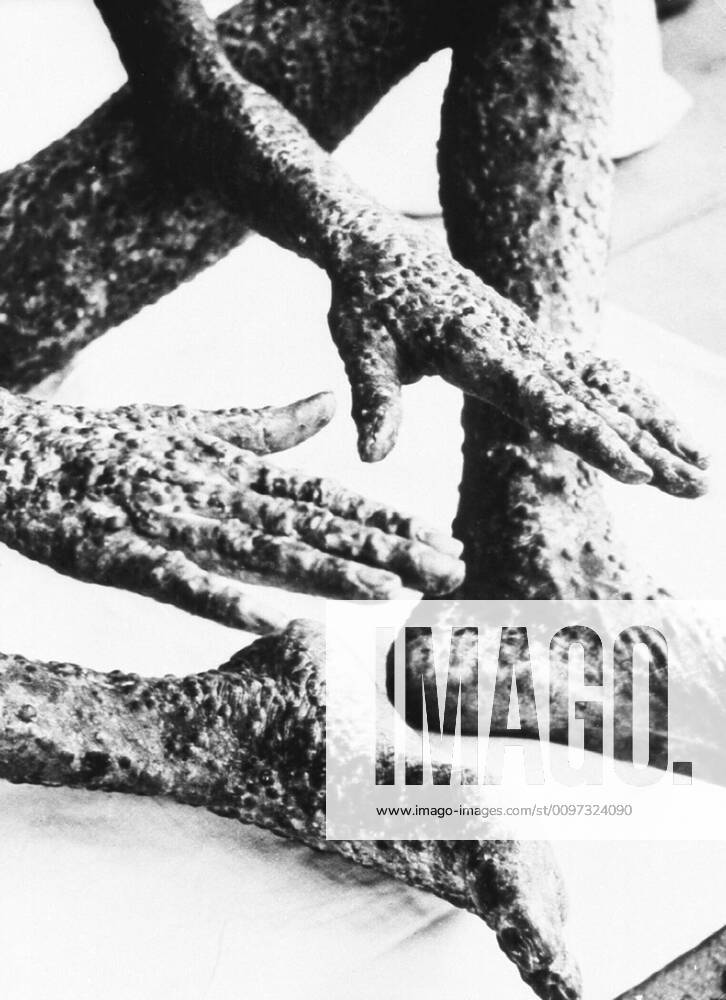 The heavily pockmarked hands, legs, and feet of a smallpox victim in ...