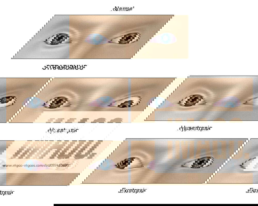 Medical illustration showing strabismus, a condition where the eyes do ...