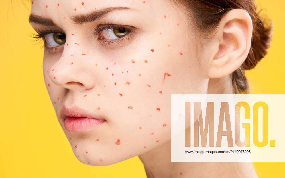 Woman With Red Dots On Her Face Skin Problems Dermatology woman-with-red-dots-on-her-face-skin-problems-dermatology