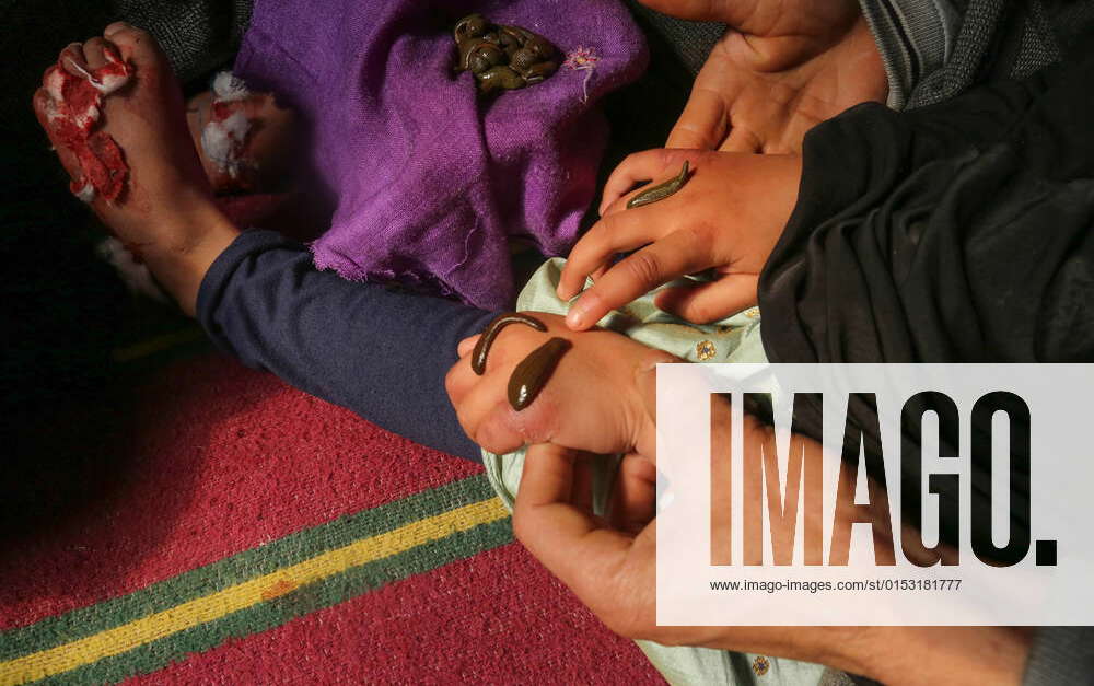 India: Leech Therapy in Kashmir Leeches are placed by a local ...