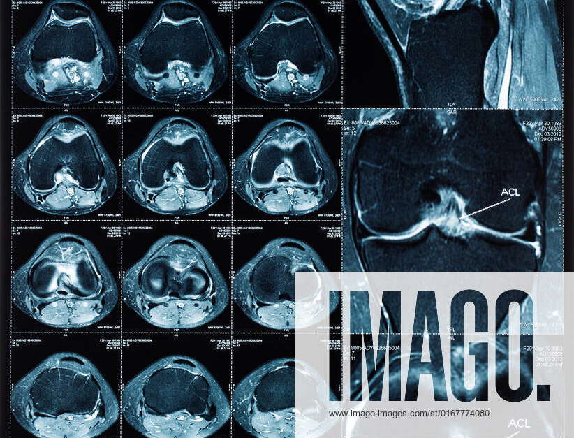 knee,mri,magnetic resonance imaging,knees,mris,mri scan