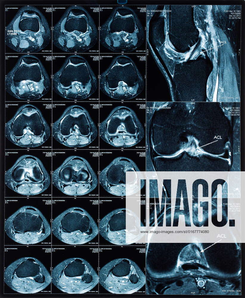 knee, mri, magnetic resonance imaging, knees, mris, mri scan