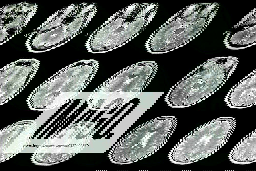 MRI scan of patient brain with normal signal intensity of the brain ...