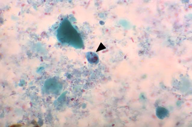 Entamoeba hartmanni This photomicrograph of an iron-hematoxylin stained ...