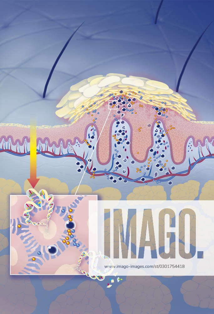 Psoriasis Sectional psoriasis, erythemato-squamous plaque ...