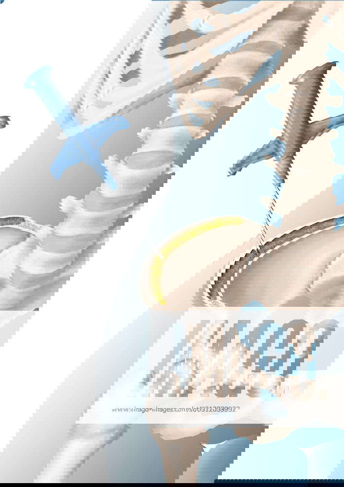 Bone marrow aspiration Iliac puncture, MallarmÃ trocar